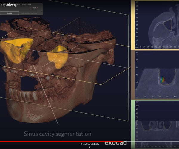 In Office Surgical Guide Solution – CM MEDICAL - Digital Dentistry ...