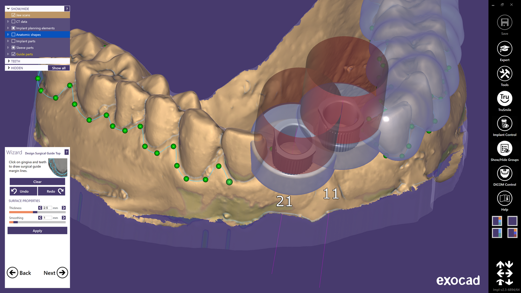 Exoplan (Surgical Guide by Exocad) – CM MEDICAL - Digital Dentistry ...